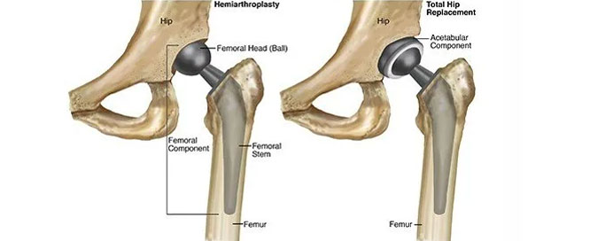 Total Hip Replacement Surgery in Malad - Hip Replacement